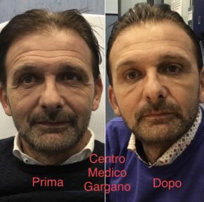 Botulino Viso Uomo: Prima e Dopo – Centro Medico Gargano